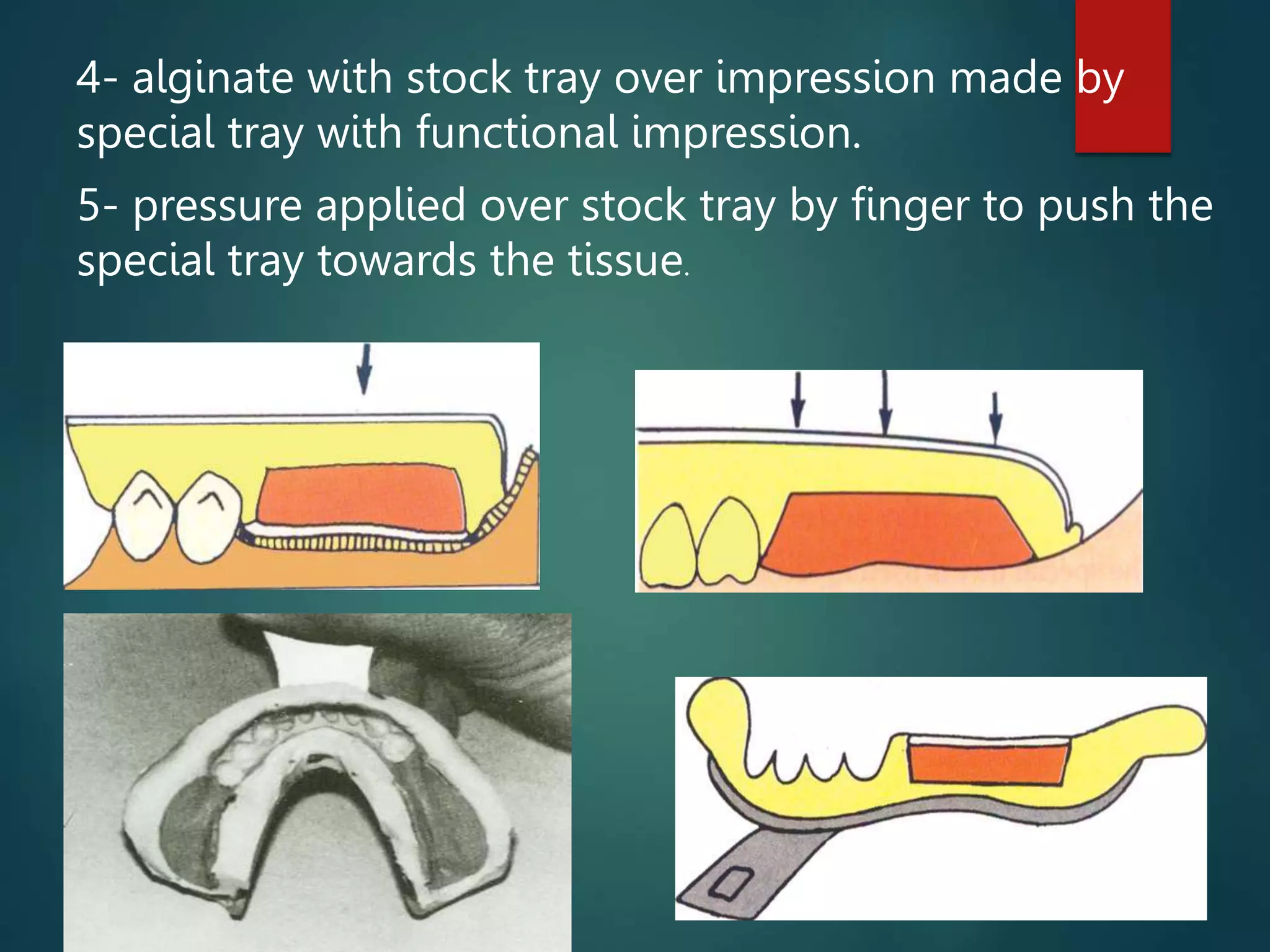 Secondary impression and master cast for RPD (0).pptx