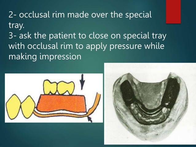 Secondary impression and master cast for RPD (0).pptx | Dental Health ...