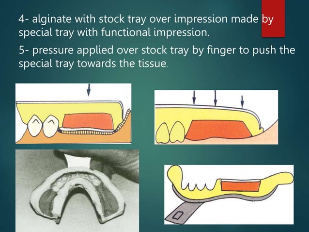 Secondary impression and master cast for RPD (0).pptx | Dental Health ...