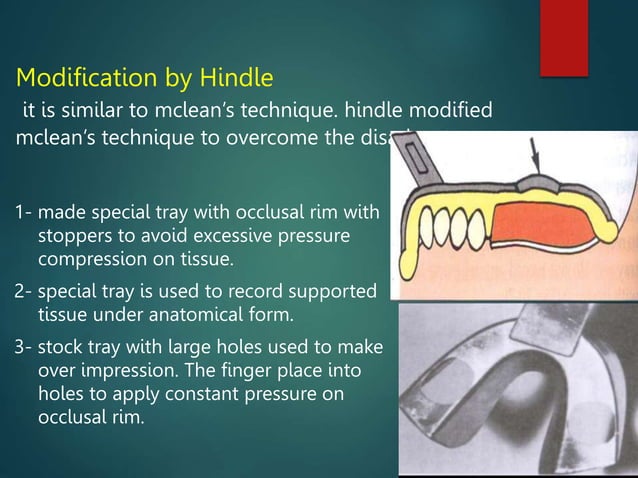 Secondary impression and master cast for RPD (0).pptx | Dental Health ...