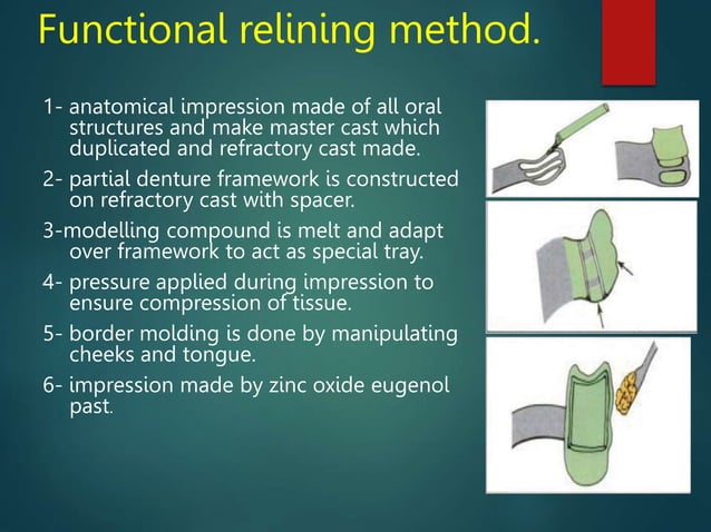 Secondary impression and master cast for RPD (0).pptx | Dental Health ...
