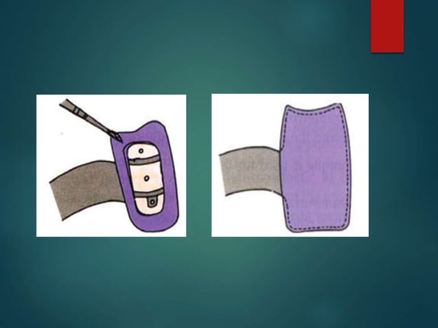 Secondary impression and master cast for RPD (0).pptx | Dental Health ...