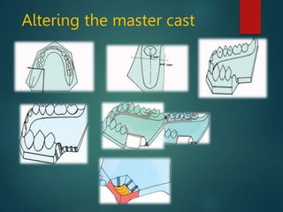 Secondary impression and master cast for RPD (0).pptx