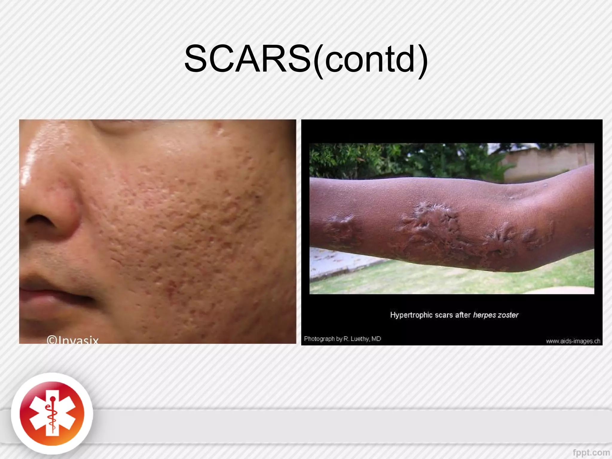 Secondary lesions & Special lesions in dermatology | PPT