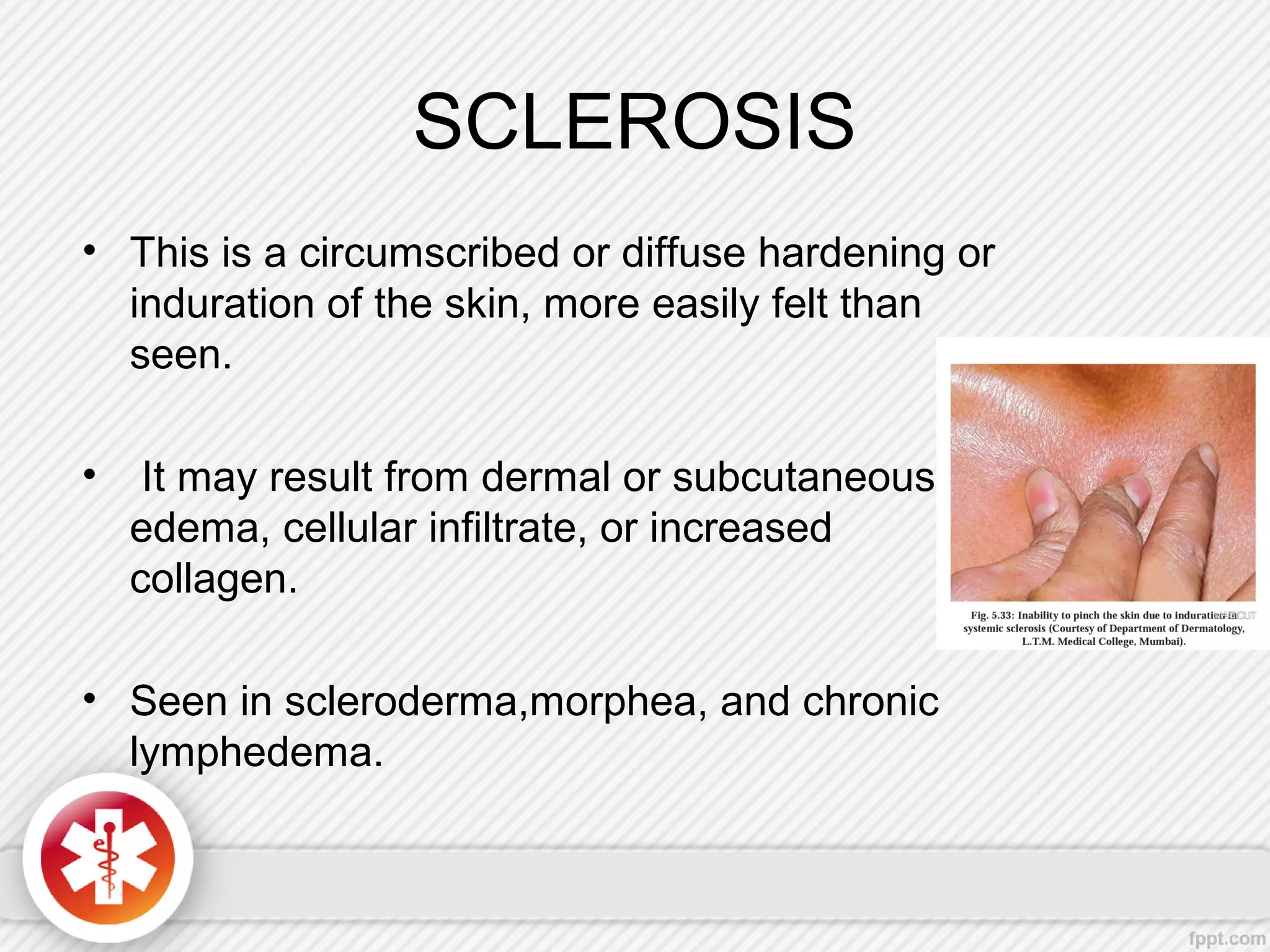 Secondary lesions & Special lesions in dermatology | PPT