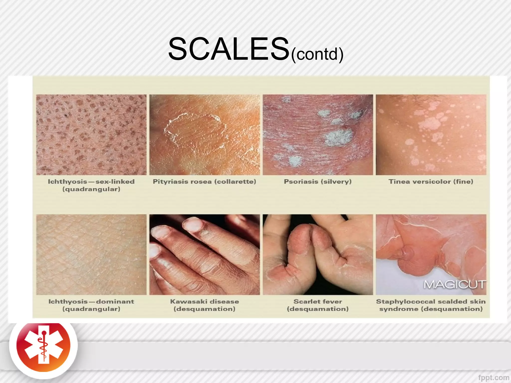 Secondary lesions & Special lesions in dermatology | PPT
