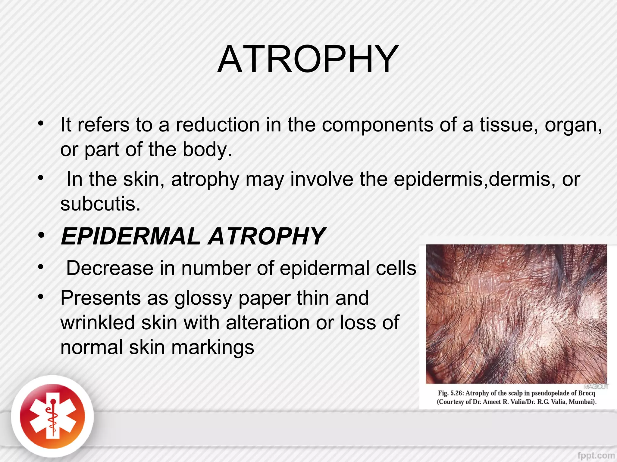 Secondary lesions & Special lesions in dermatology | PPT