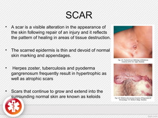 Secondary lesions & Special lesions in dermatology | PPT