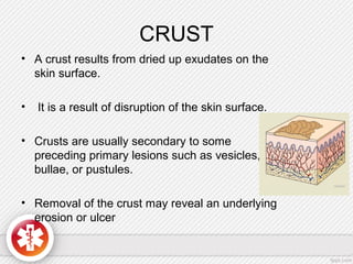Secondary lesions & Special lesions in dermatology | PPT