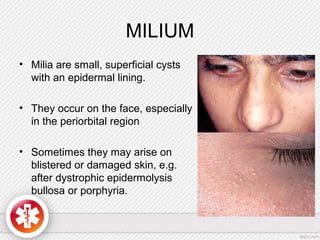 Secondary lesions & Special lesions in dermatology | PPT