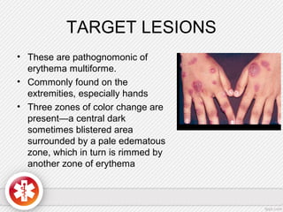 Secondary lesions & Special lesions in dermatology | PPT