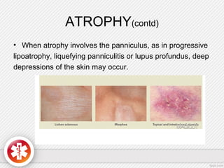 Secondary lesions & Special lesions in dermatology | PPT