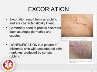 Excoriation Skin Lesion