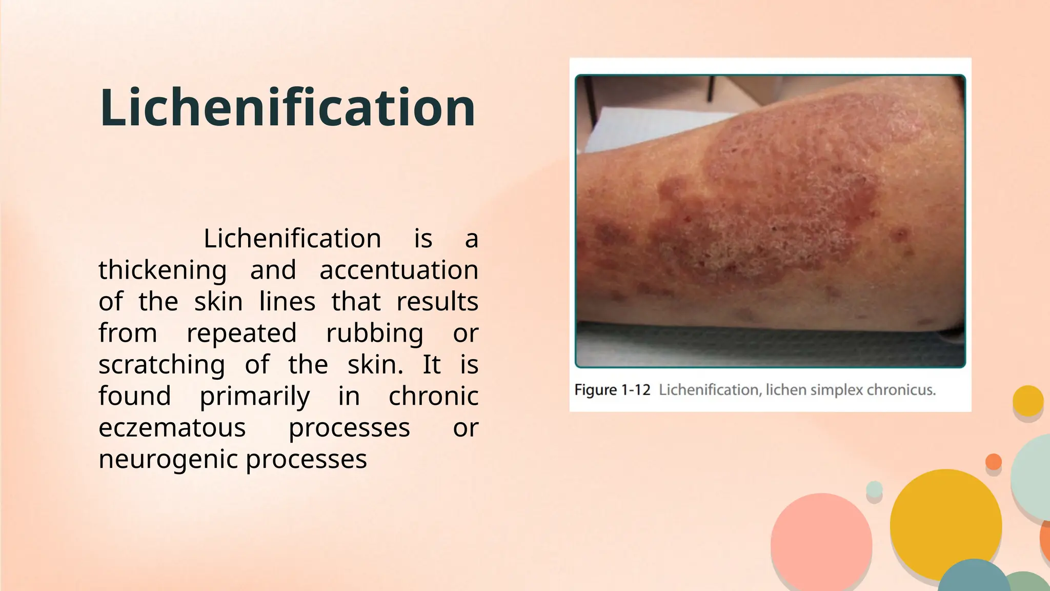 DERMATOLOGY SKIN PIGMENT Secondary Lesions.pptx