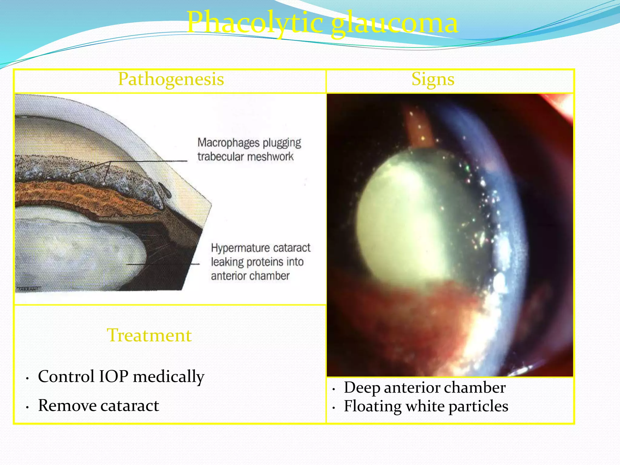 Secondary open angle glaucoma | PPTX