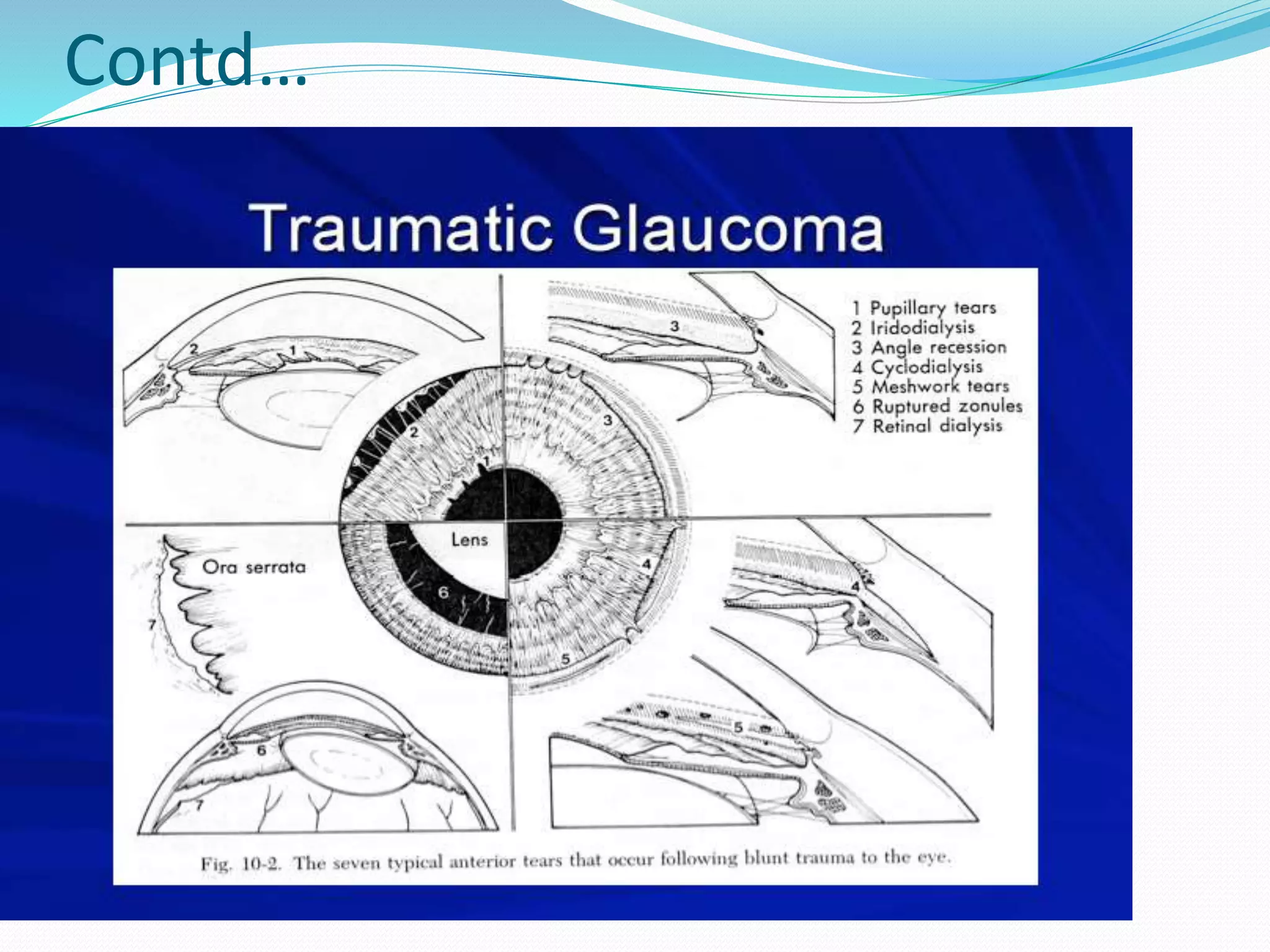 Secondary open angle glaucoma | PPTX