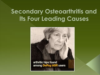 Secondary osteoarthritis and its four leading causes | PPTX