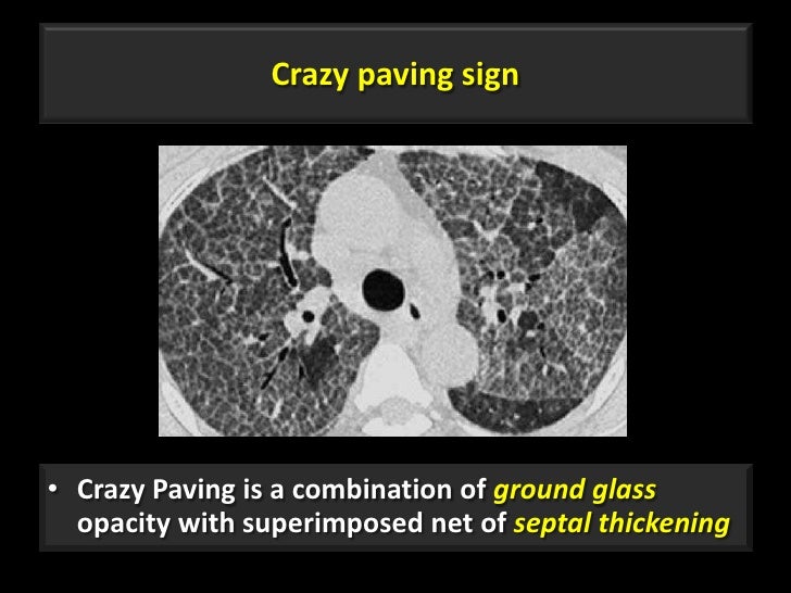 Secondary pulmonary lobule crazy paving sign
