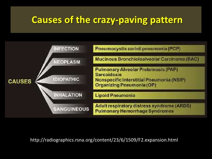 Secondary pulmonary lobule crazy paving sign