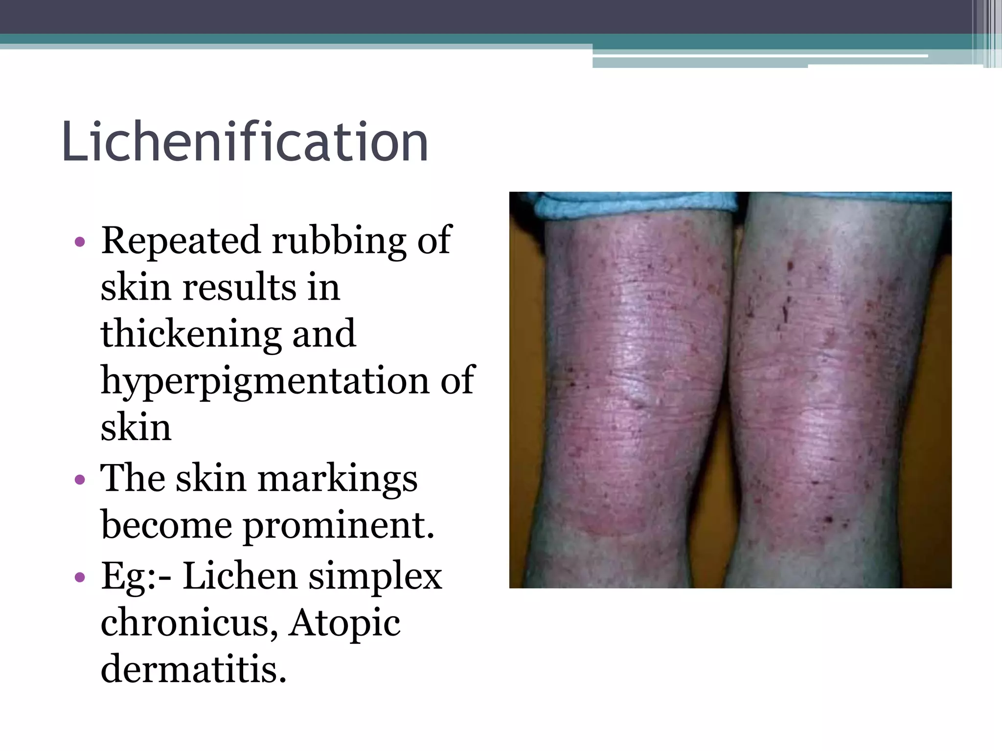 Secondary skin lesions | PPTX