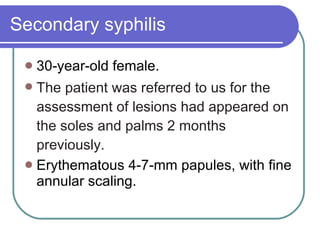 Secondary Syphilis | PPT