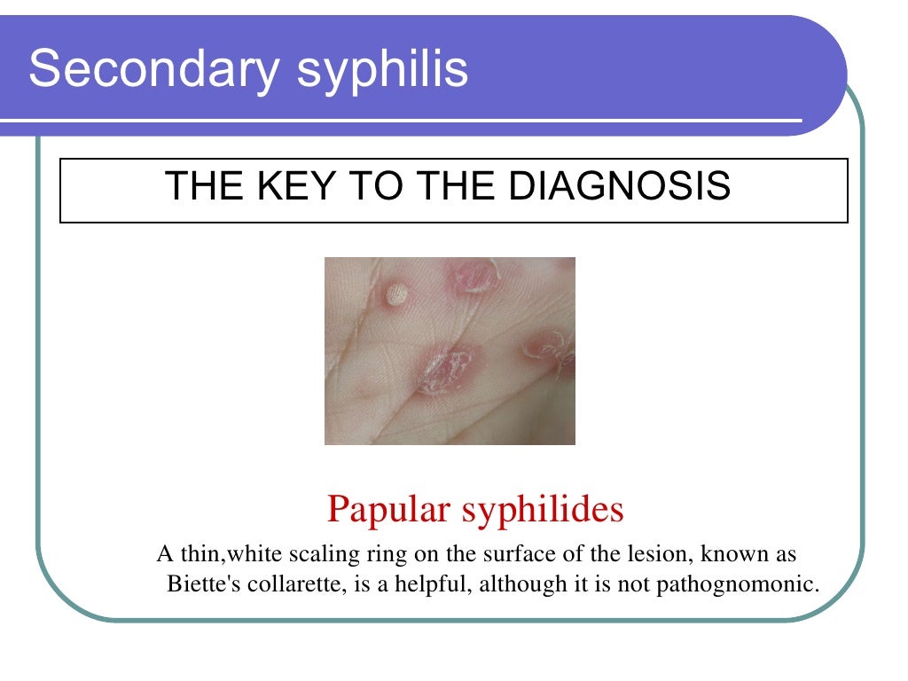Secondary Syphilis
