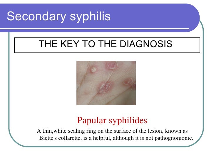 Secondary Syphilis