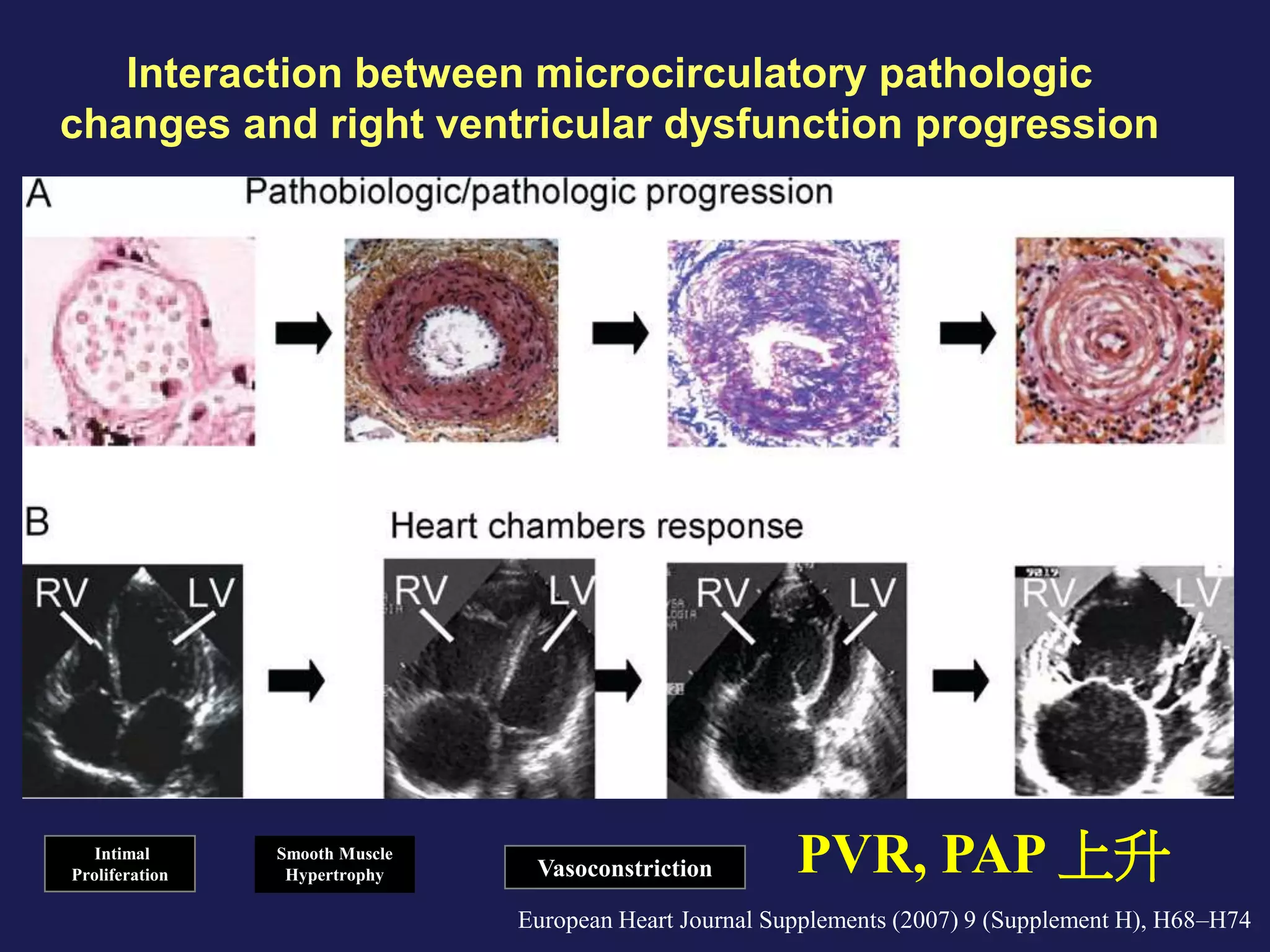 Current diagnosis and management of PAH from cardiologist point of view ...