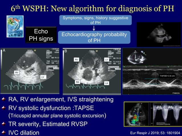 Current diagnosis and management of PAH from cardiologist point of view ...