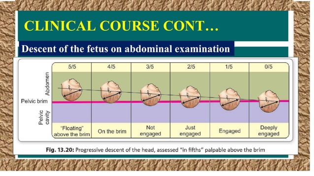 Second stage management of labour | PPTX