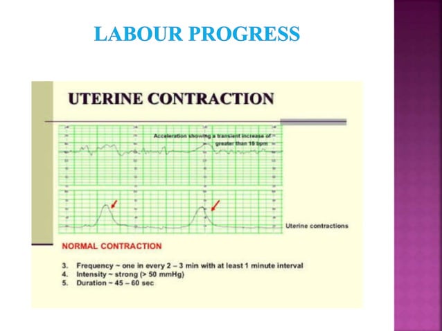 Second stage of labour | PPTX