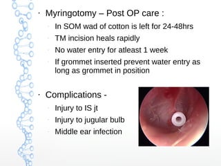 Secretory otitis media | ODP