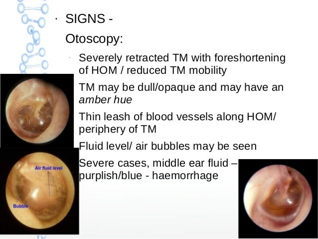 Secretory otitis media