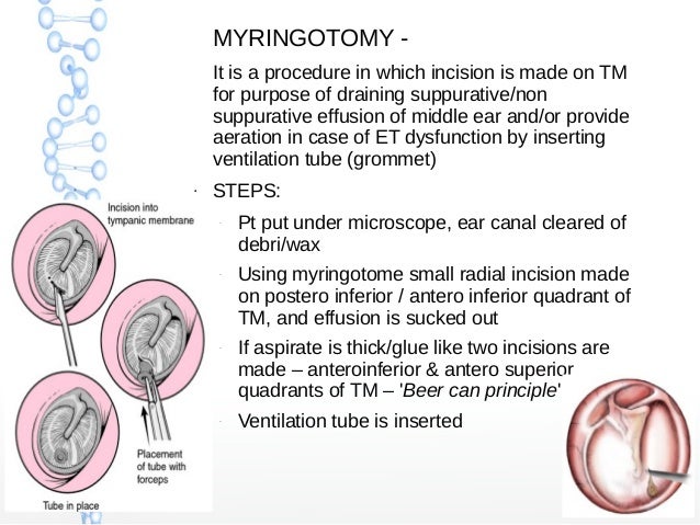 Secretory otitis media