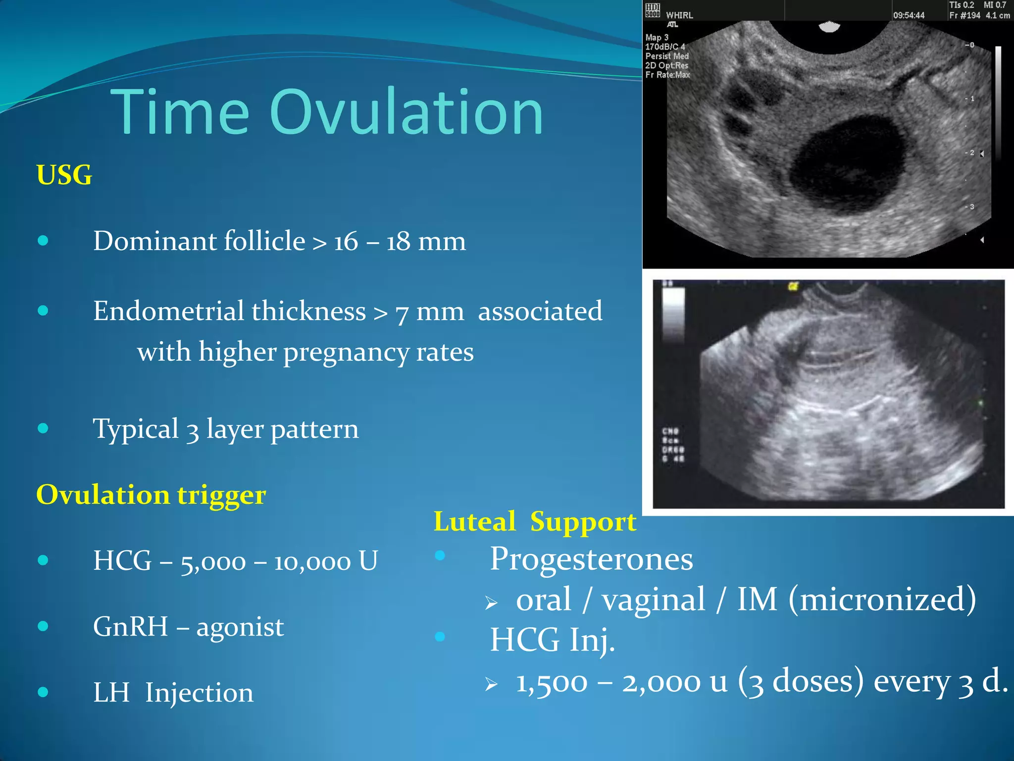 Secrets for success of Intra Uterine Insemination (IUI) | PDF