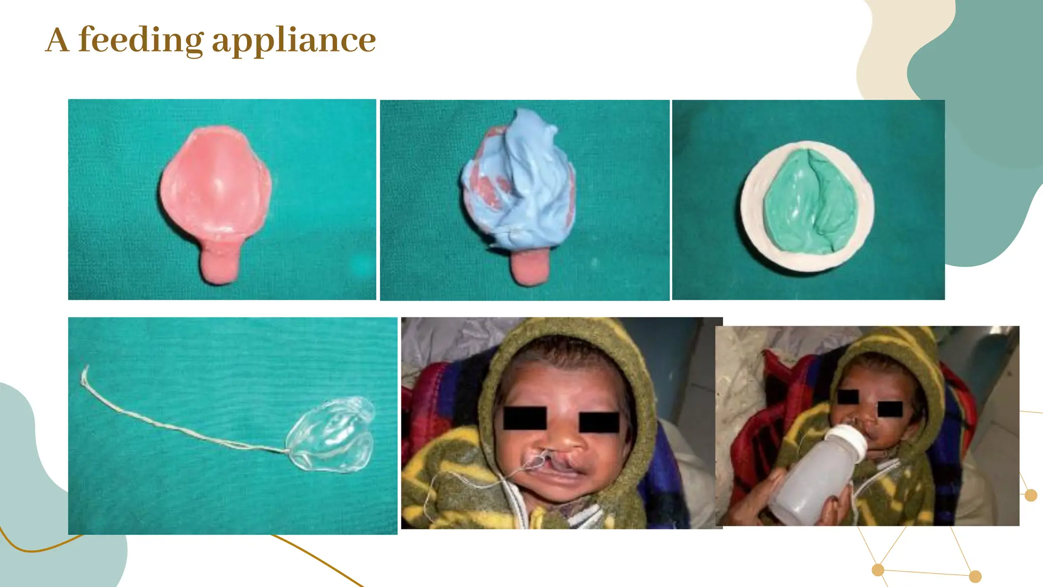 Cleft lip and palate and prosthesis neonates | PDF