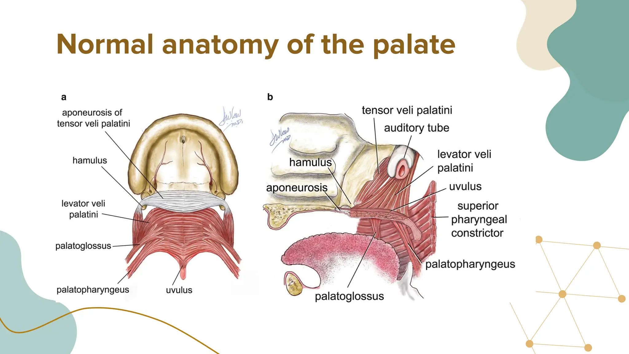 Cleft lip and palate and prosthesis neonates | PDF