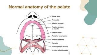 Cleft lip and palate and prosthesis neonates | PPT