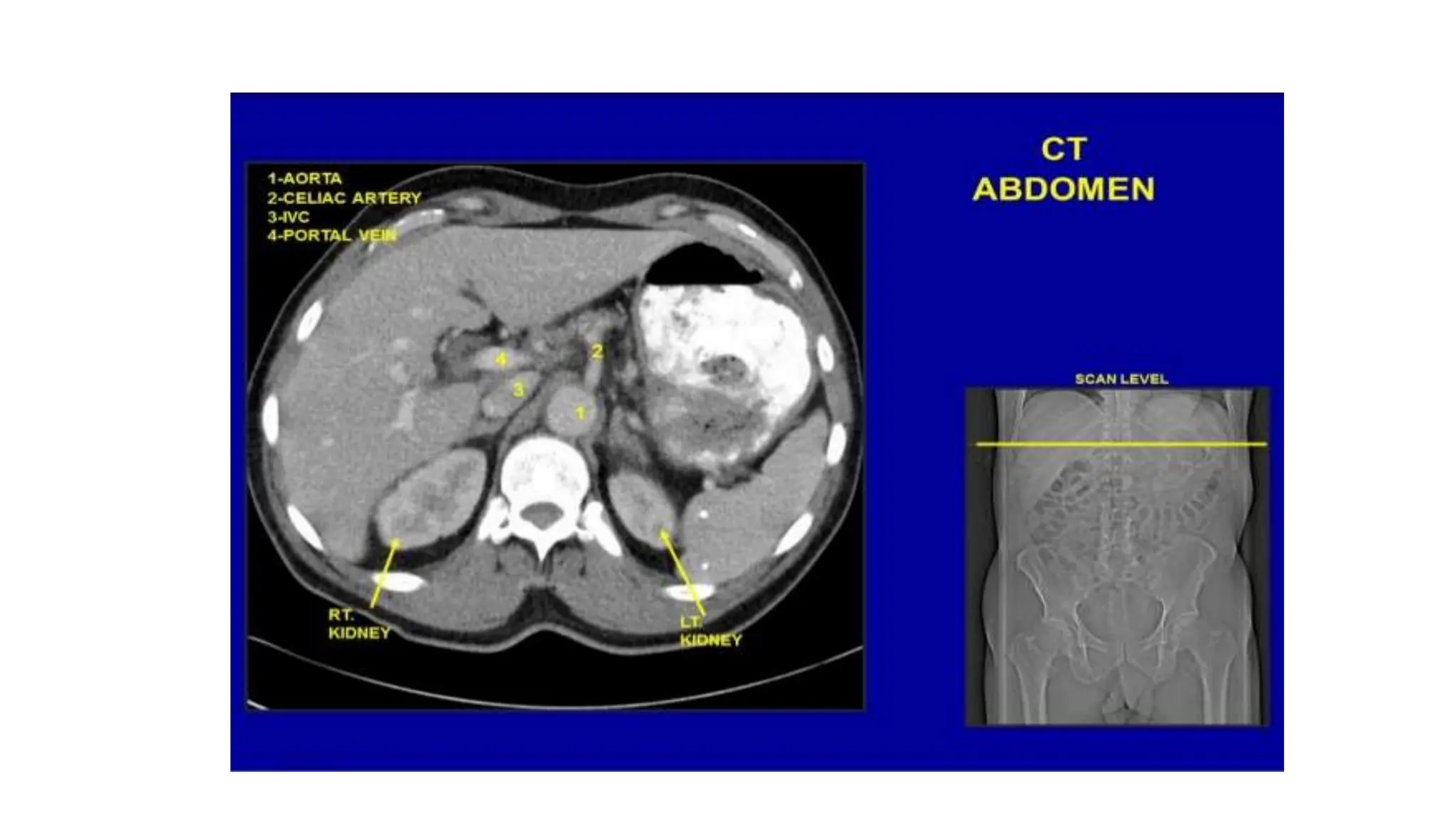 Section 1 CT Abdomen and Pelvis by doctor Aya Ali Taha | PPTX