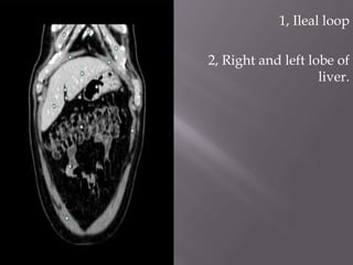 Sectional anatomy of abdomen | PPTX