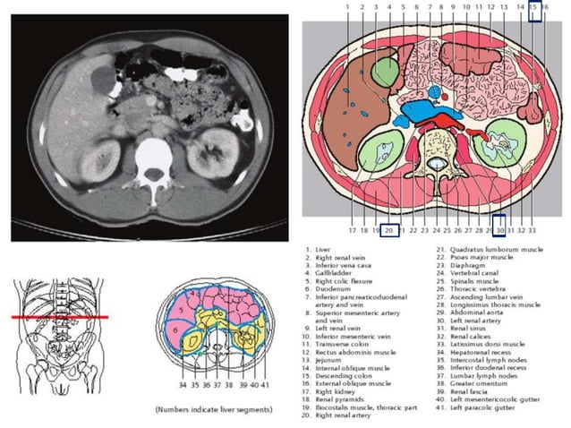 Sectional radio-anatomy of abdomen | PPTX