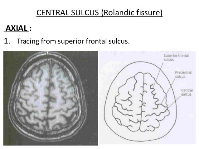 Imaging sectional anatomy of brain part 1