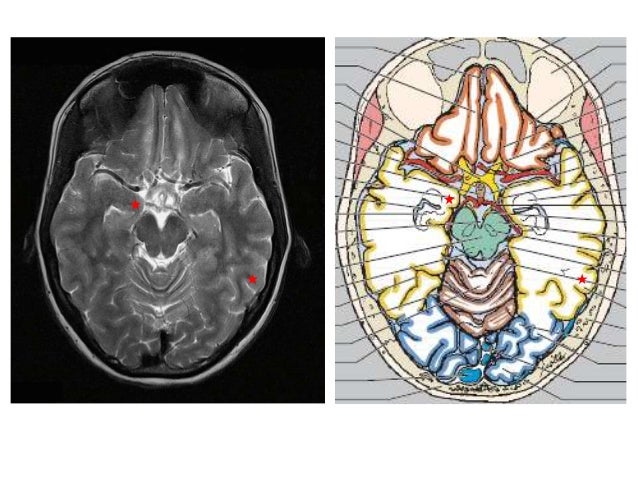 Sca Brain Anatomy