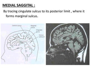 Sectional anatomy of brain part 1 | PPTX
