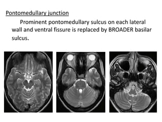 Imaging sectional anatomy of brain part 2 | PPTX