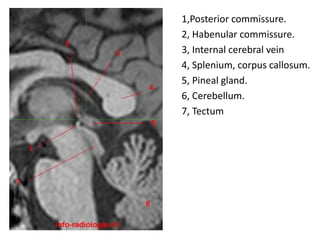 Sectional anatomy of brain part 2 | PPTX
