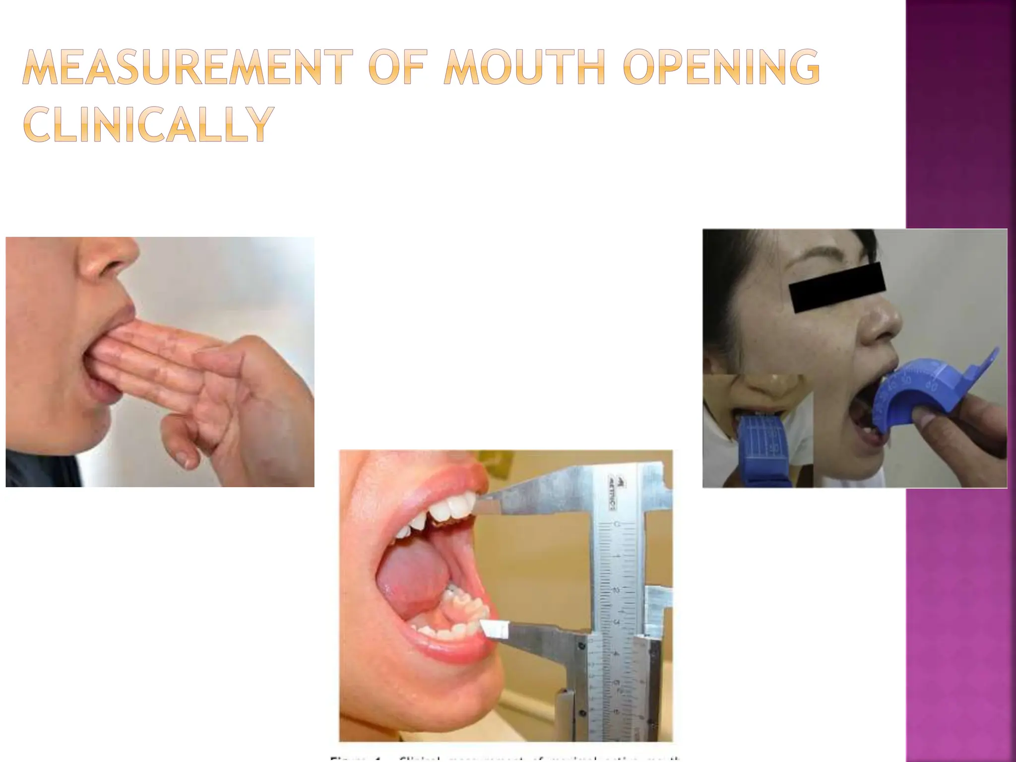 Sectional dentures for microstomia patients.pptx