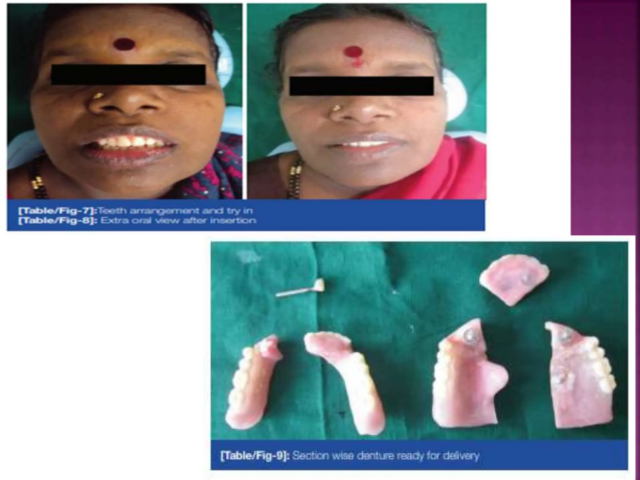 Sectional dentures for microstomia patients.pptx