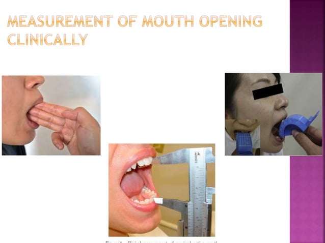 Sectional dentures for microstomia patients.pptx | Oral care | Personal ...