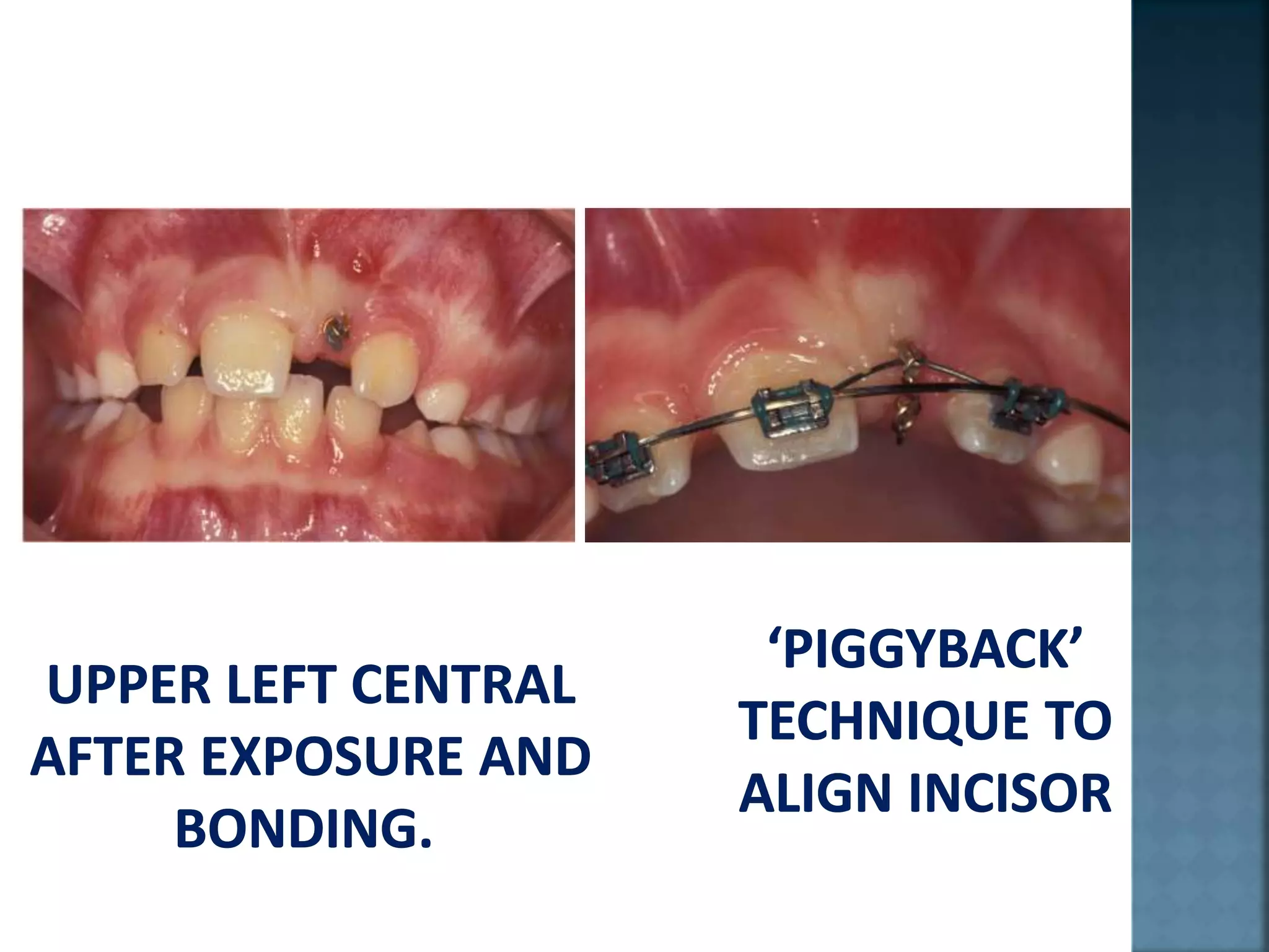 Sectional fixed orthodontic appliance | PPTX